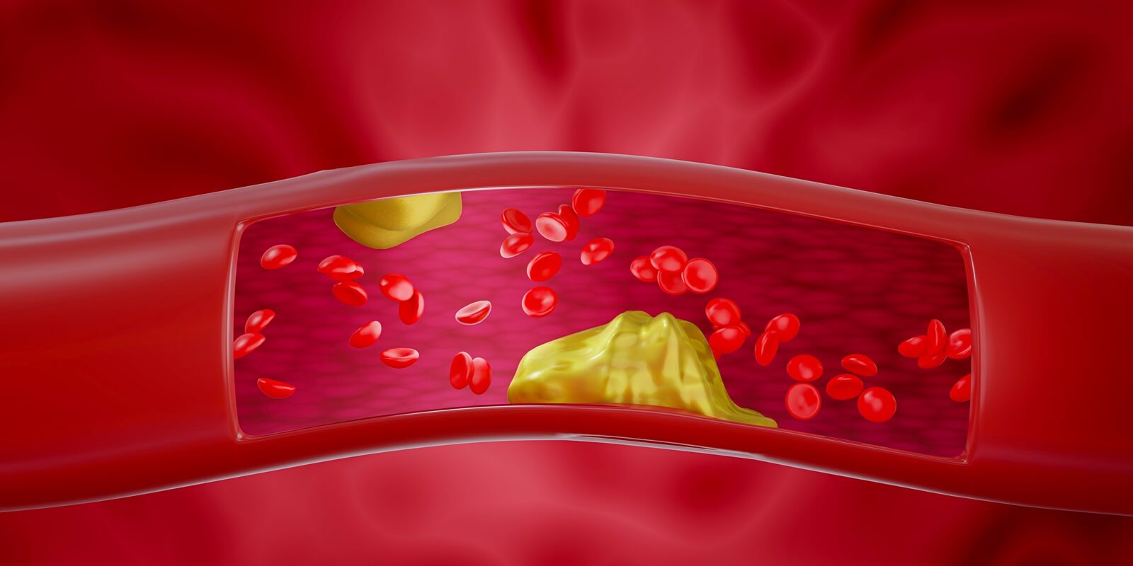 High LDL Cholesterol Health Risks - Imperial Center Family Medicine