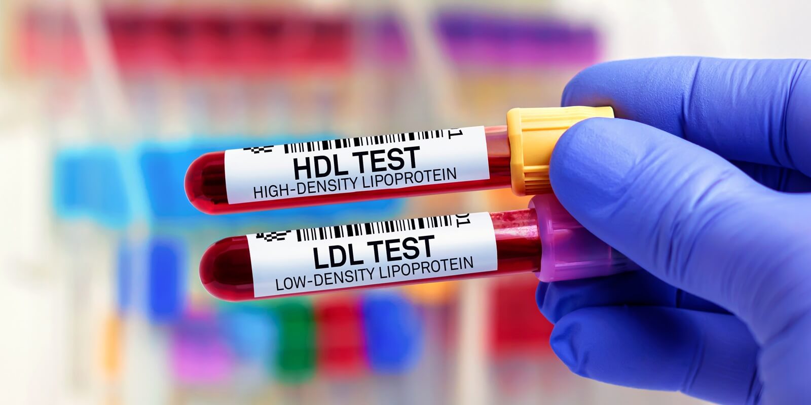 High Cholesterol and Its Link to Heart Disease - Imperial Center Family Medicine